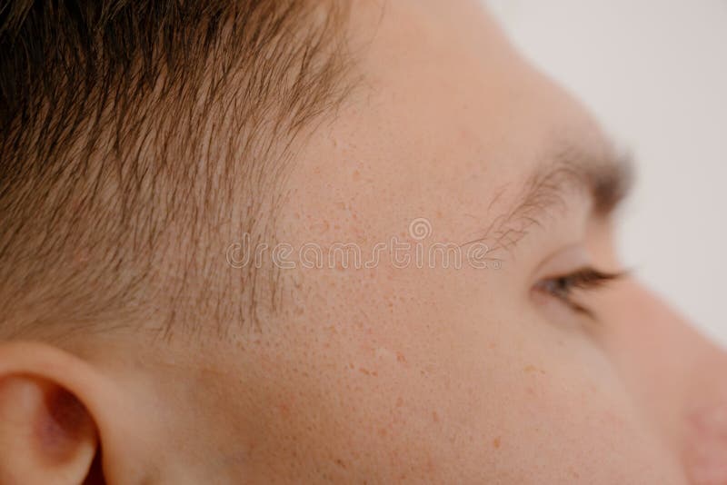 Acne scars on the face stock image. Image of medical - 243187031