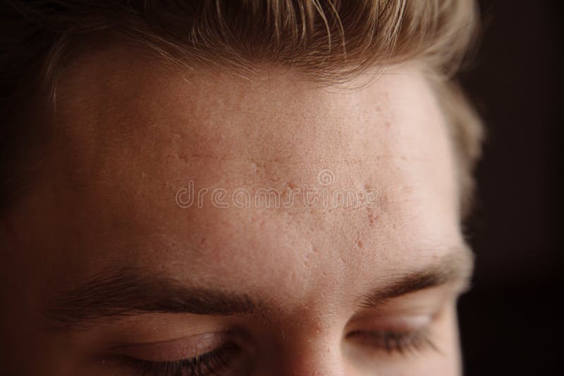 Acne scars on the face stock image. Image of health - 180490179