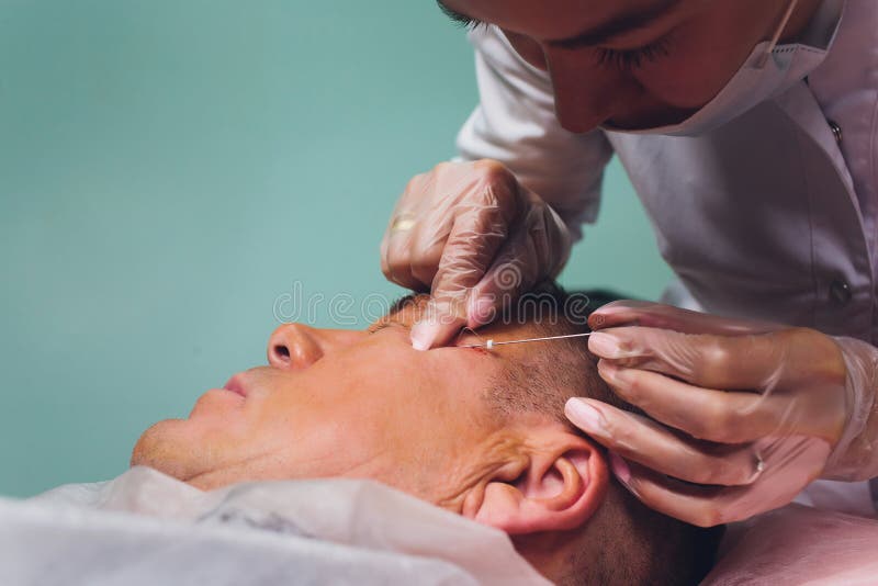 Close-up of Procedure for Face Lifting PDO Suture Operation, Face ...