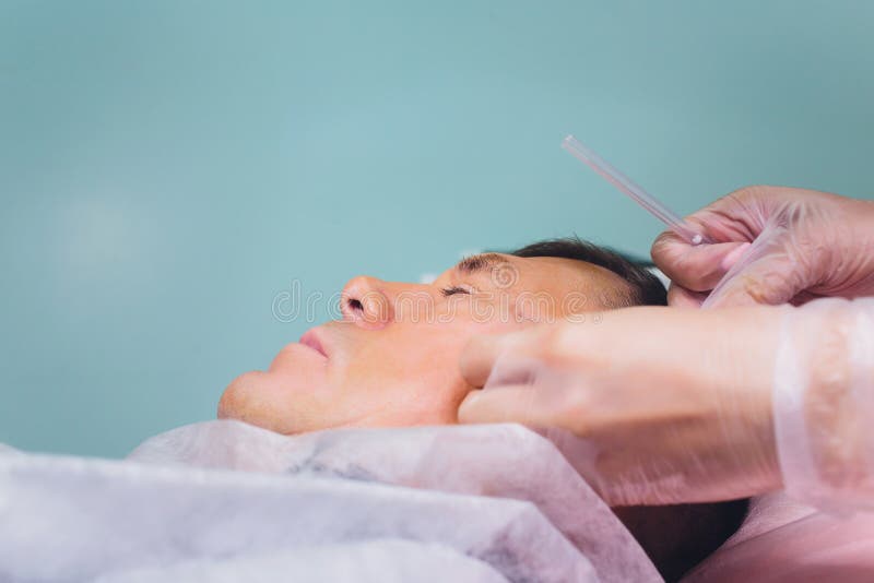 Close-up of Procedure for Face Lifting PDO Suture Operation, Face ...