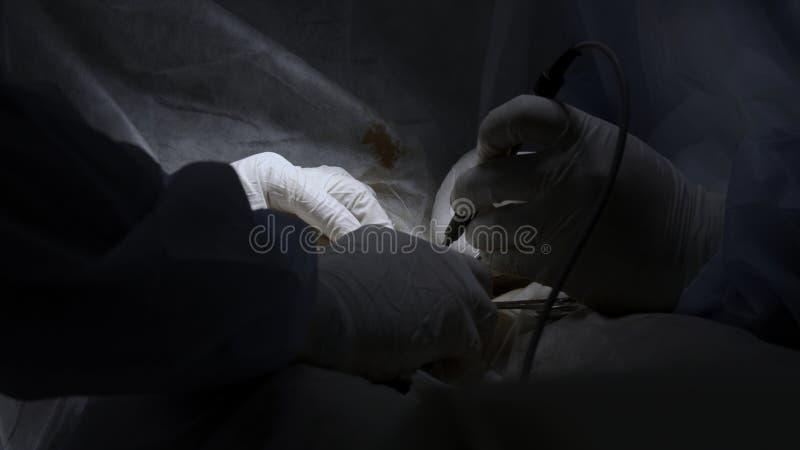 Close Up of Professional Surgeons Cauterizing an Open Wound during ...