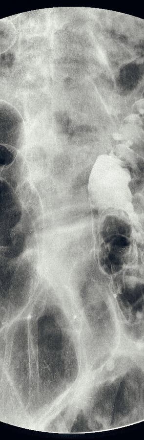 Close Up X-ray Barium Enema Examination. Colorectal X-ray Stock Image ...