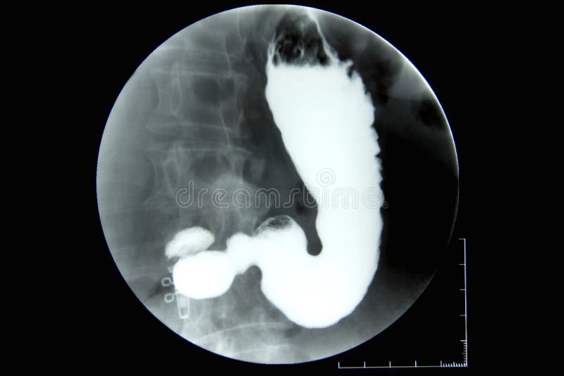 Close Up X-ray Image of Stomach Stock Image - Image of patient, human ...