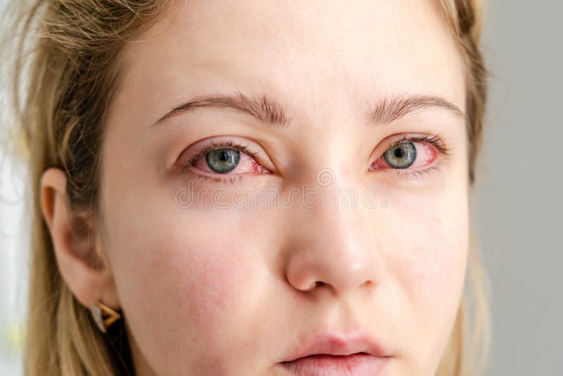 Close Up of Red Irritated Human Eyes, Allergy Symptom, Conjunctivitis ...
