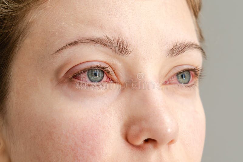 Close Up of Red Irritated Human Eyes, Allergy Symptom, Conjunctivitis ...