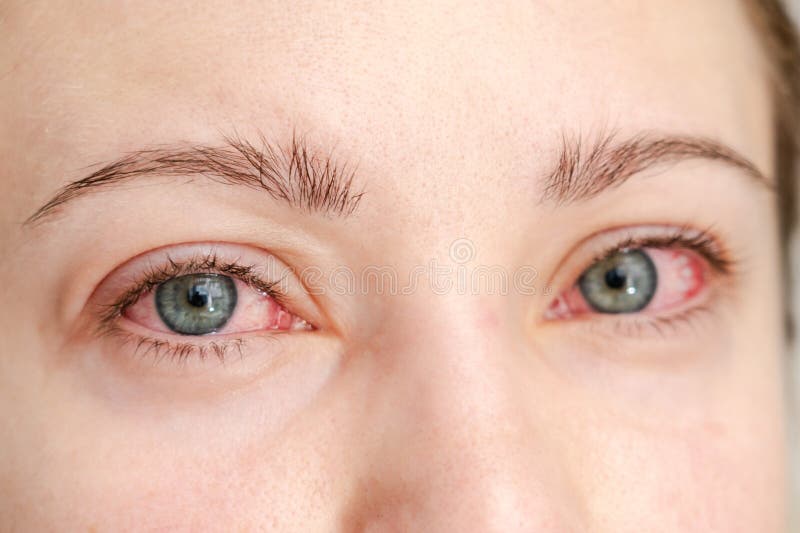 Close Up of Red Irritated Human Eyes, Allergy Symptom, Conjunctivitis ...