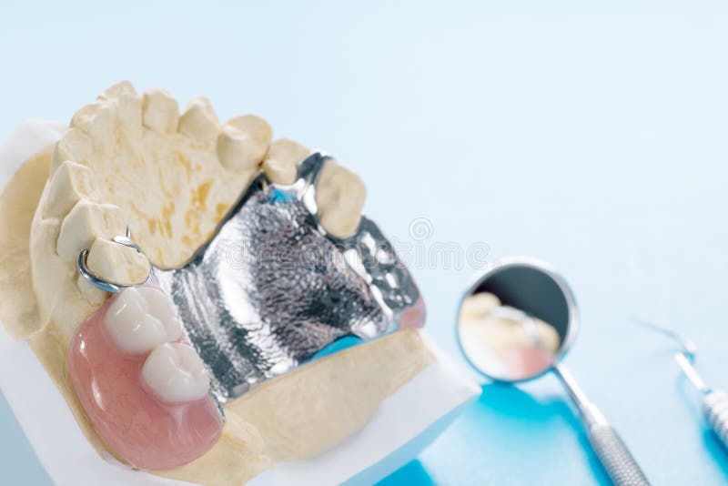 Removable Partial Denture RPD. Stock Photo - Image of clean, background ...
