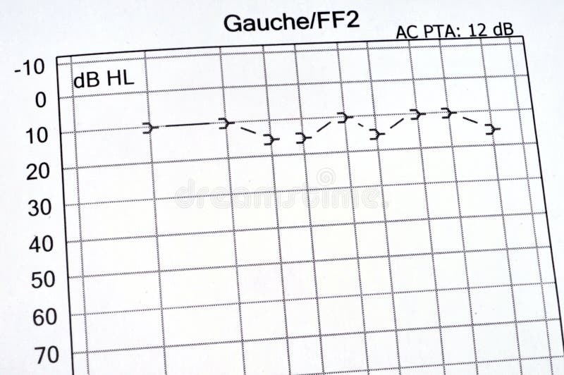 Presbycusis Stock Illustrations – 11 Presbycusis Stock Illustrations ...