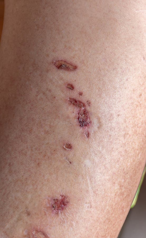 Close up scab on the legs stock photo. Image of fall - 287928274
