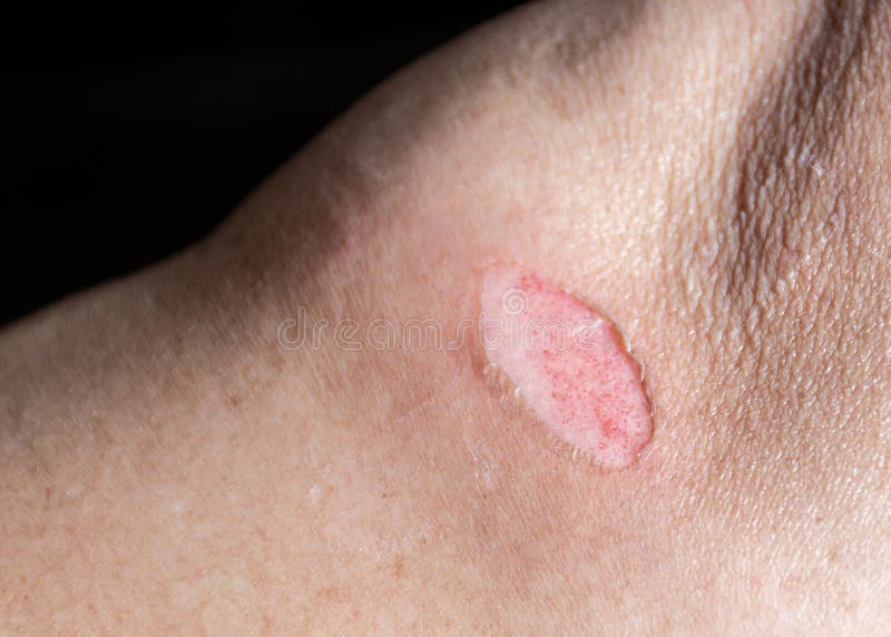 Close up scab on the legs stock image. Image of hospital - 325610779