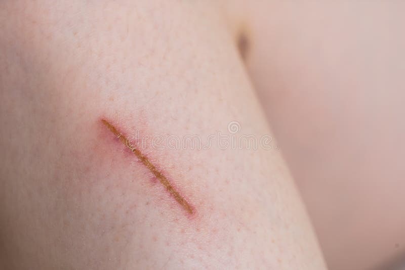 Close up scar on skin stock image. Image of injury, health - 119242463