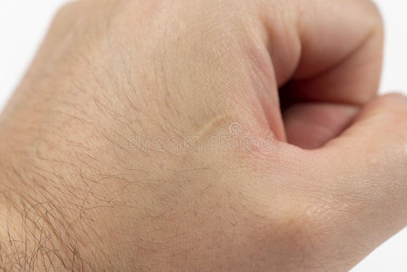 Close Up Scar on Skin. the Wound Form Scabs on Leg. Man with Long Scab ...