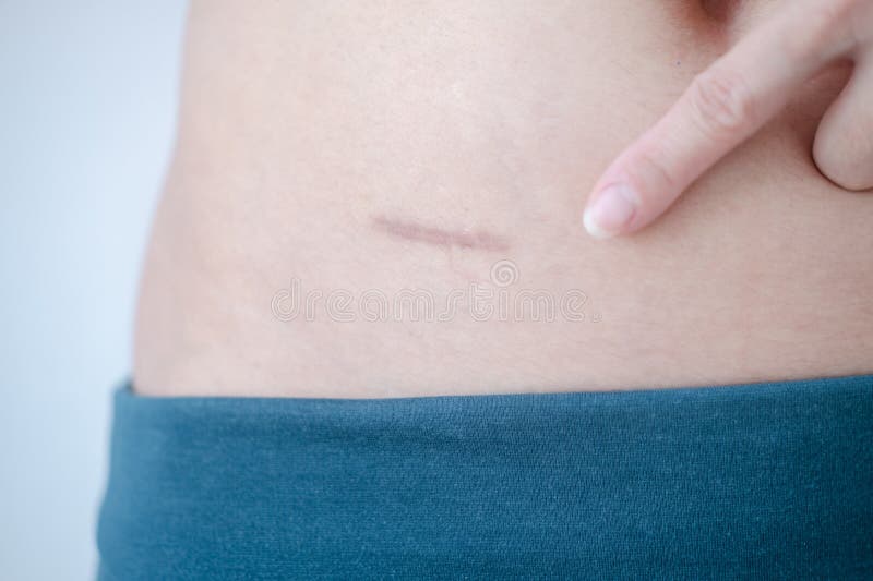 Close-up of Scars after Appendix Surgery Stock Photo - Image of body ...