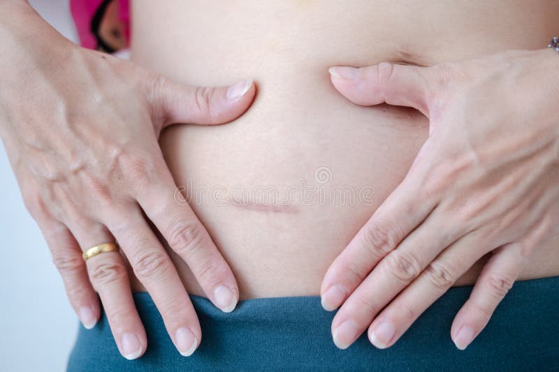Close-up of Scars after Appendix Surgery Stock Image - Image of belly ...