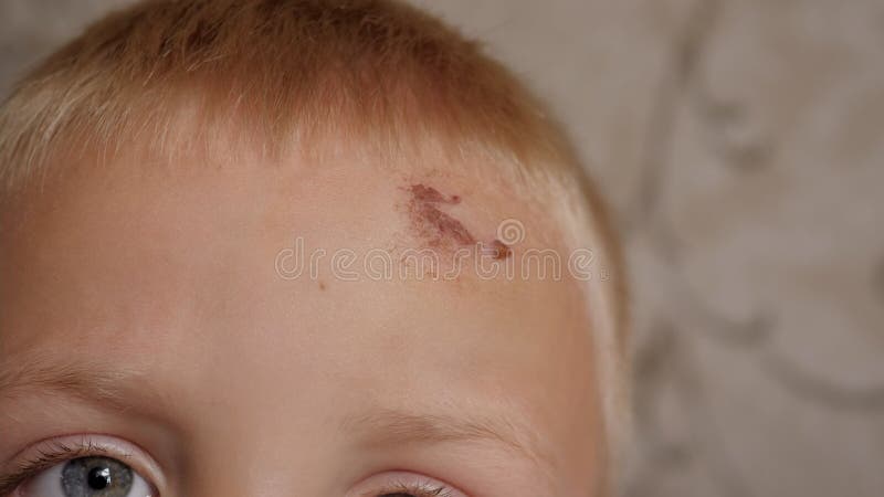 Close-up of a Scratch and a Bump on the Forehead of a Small Boy. Stock ...