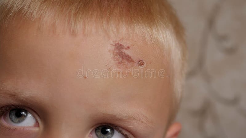 Close-up of a Scratch and a Bump on the Forehead of a Small Boy. Stock ...