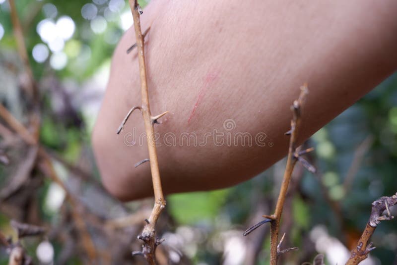 Scratch Scar from Thorns on the Arm Stock Photo - Image of trees ...