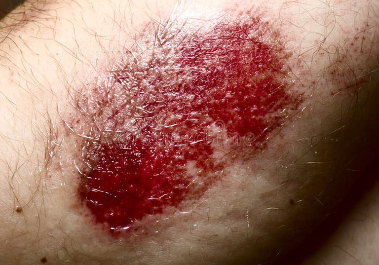 Close-up of a Scratched Wound on Elbow Stock Image - Image of nasty ...
