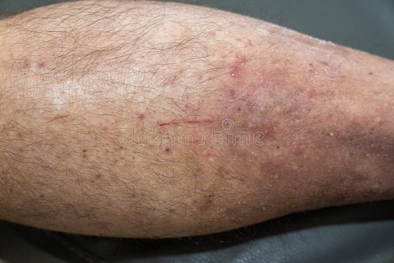 Close Up of Seborrheic Dermatitis Stock Photo - Image of symptom, body ...