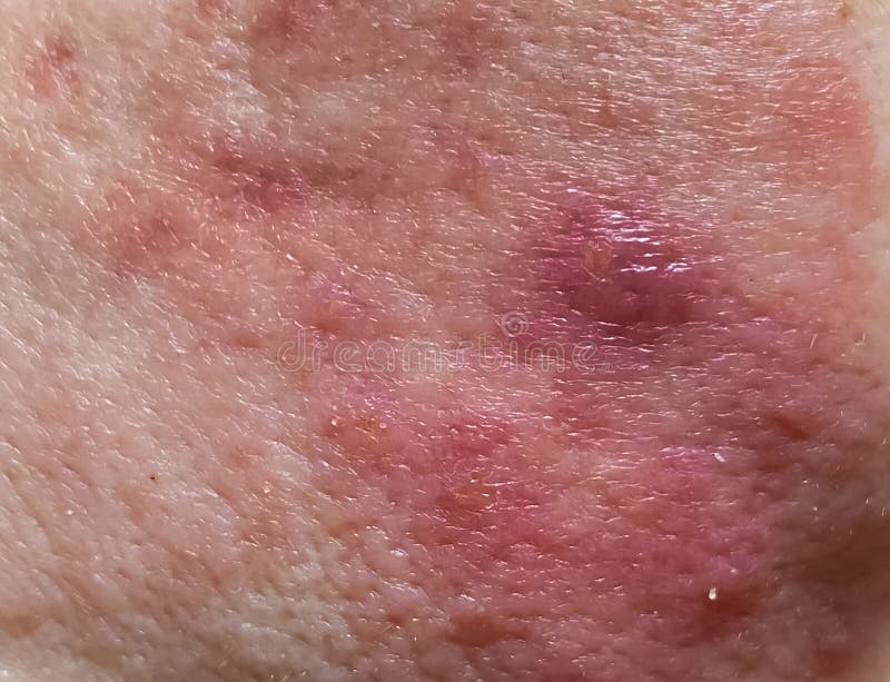 Close-up, Selective Focus, Dermatological Infection of the Skin, in ...