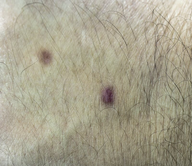 Close Up Shooting of an Male Hand with Human Skin Sarcoma Stock Photo ...