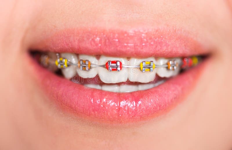 Close-up Shot of Multicolored Bracket Systems Stock Photo - Image of ...