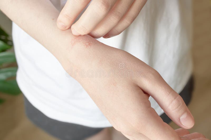 Close-up of Skin with Allergic Skin Disease with Redness and Itching ...