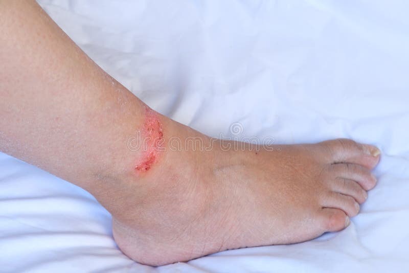 The Chronic Dermatitis Rash Hives Allergy And Peeling Skin Stock