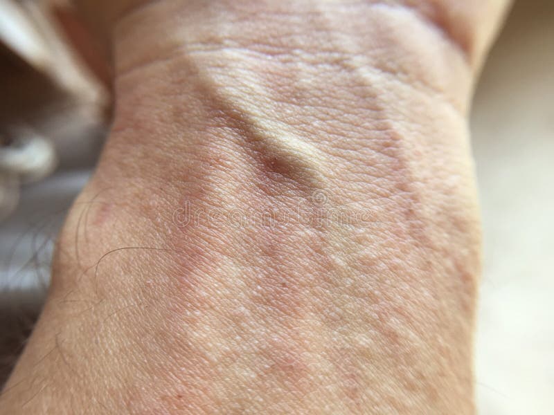 Skin rash on man hand stock photo. Image of scratch - 145977618