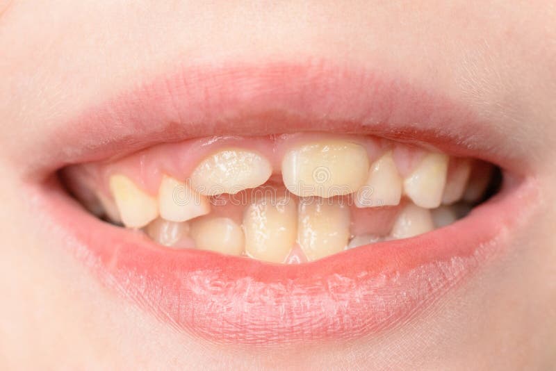 Close-up of a Small Boy with Curved Teeth Smiling Stock Image - Image ...