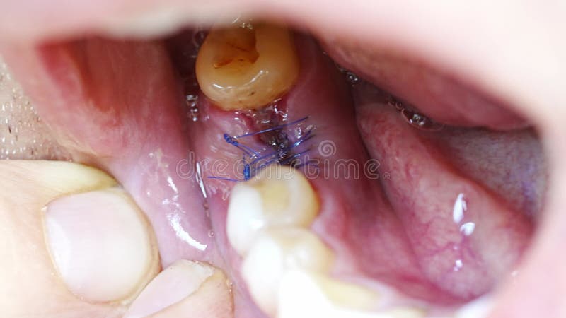 Close-up. a Sutured Socket in the Oral Cavity after Tooth Extraction ...