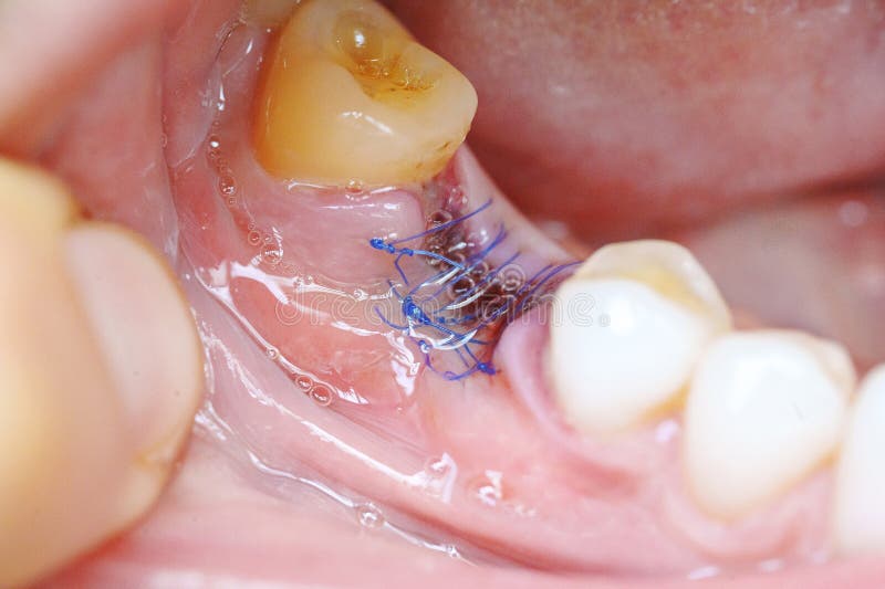 Close-up. a Sutured Socket in the Oral Cavity after Tooth Extraction ...