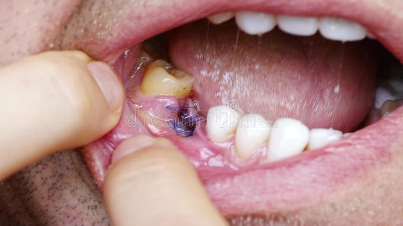 Close-up. a Sutured Socket in the Oral Cavity after Tooth Extraction ...