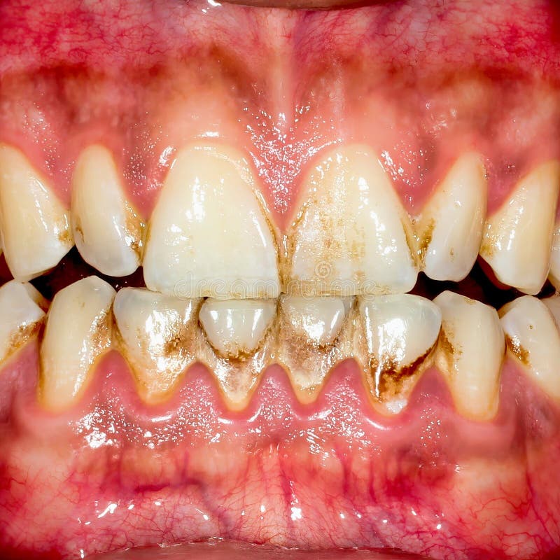 Close-Up of Teeth with Brown Stains Stock Photo - Image of unhealthy ...