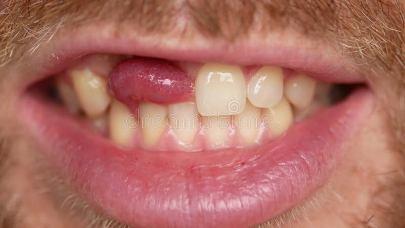 Close-up of Teeth. a Man Shows His Denture on Two Teeth Stock Video ...