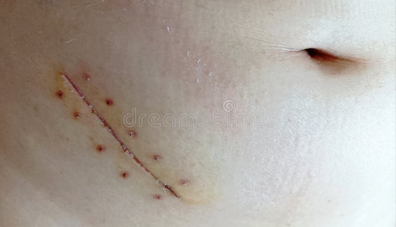 Close Up of Appendectomy Wound Stock Photo - Image of pattern, floor ...