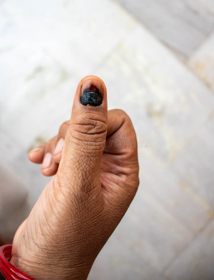 Black Eye Injury Accident Violence Isolated Stock Photo - Image of ...