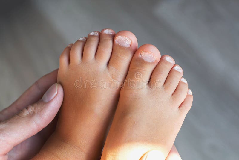 Close-up of Toenails of a 2-year-old Child, Deformed Nail Plate, Nail ... Close-up of Toenails of a 2-year-old Child, Deformed Nail Plate, Nail ...