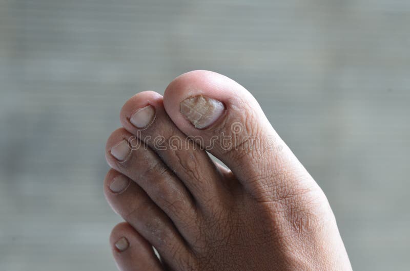 Toes of Asian Elder Man. Concept of Aging Stock Photo - Image of fungus ...