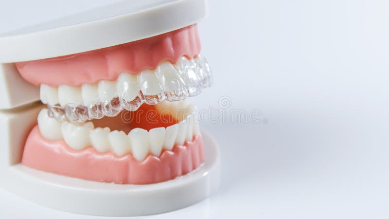 Close-up. Transparent Aligners are Placed Over the Teeth of an ...