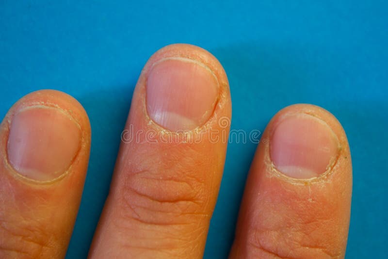 Close up of ugly nails stock photo. Image of scary, penury - 219916518