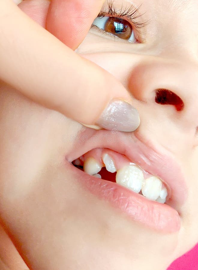 The Child Shows a Problematic Uneven Tooth. Treatment, Bite Correction ...