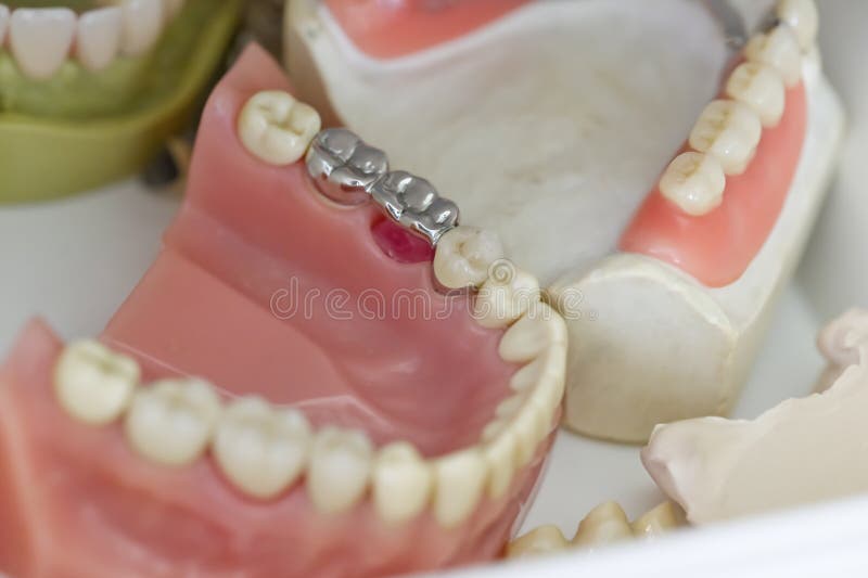 A Close-up View of Dental Models Showcasing Various Types of Teeth and ...