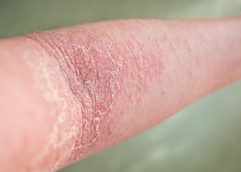 Pustular Psoriasis Stock Photos - Free & Royalty-Free Stock Photos from ...