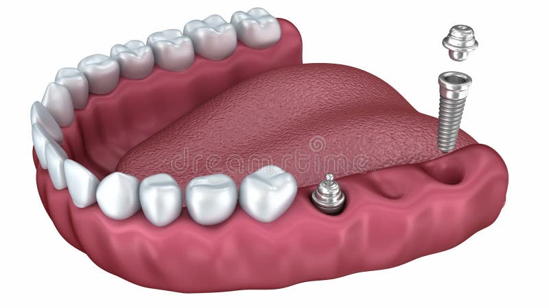 A Close-up View of Lower Teeth and Dental Implants Stock Footage ...