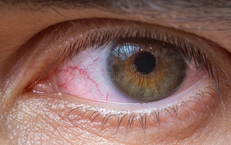 Close-up View on Red Injured or Irritated Eye. Stock Photo - Image of ...