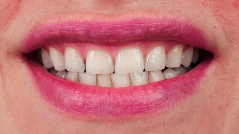 Close-up of White Teeth with Particles of Black Calculus. Dental Care ...