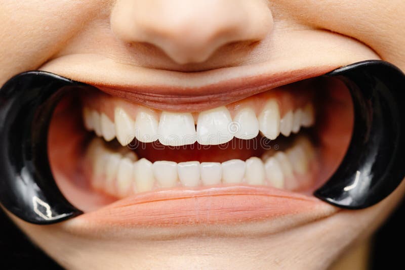Close Up of Woman Cavity Protected by Retractor Showing Perfect Teeth ...