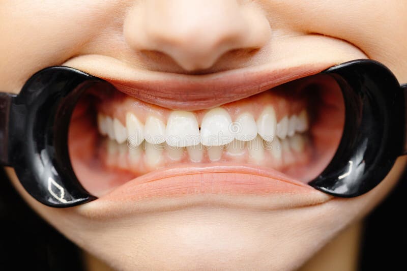 Close Up of Woman Cavity Protected by Retractor Showing Perfect Teeth ...