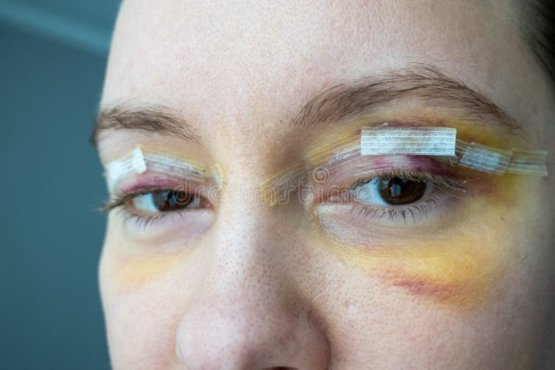 Reduce Swelling And Bruising After Eyelid Surgery Dr - vrogue.co Reduce Swelling And Bruising After Eyelid Surgery Dr - vrogue.co